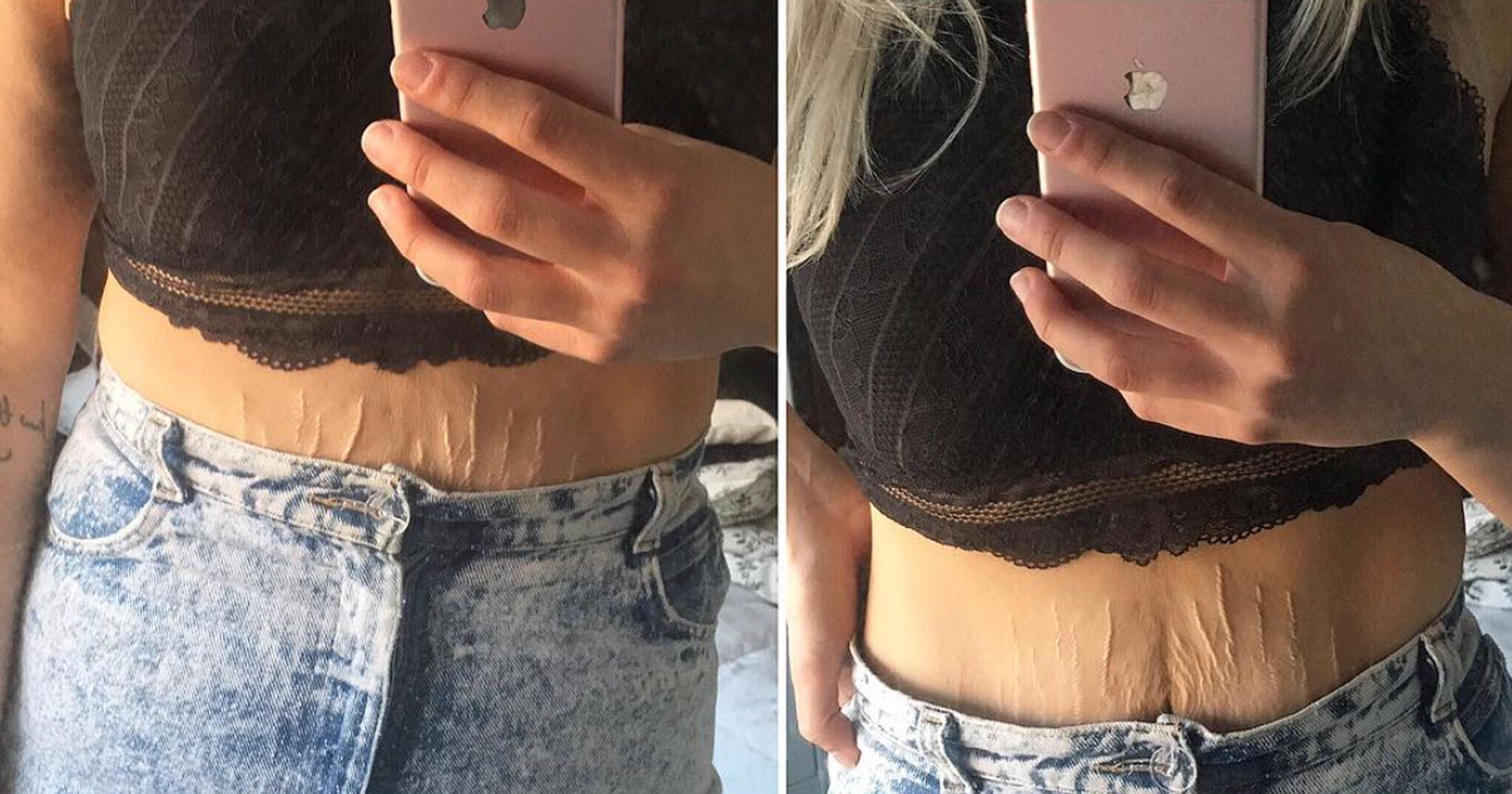 Blogger Body Positive Stretch Marks Photos Message