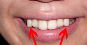 Beauty Trend – Crooked Teeth In Japan